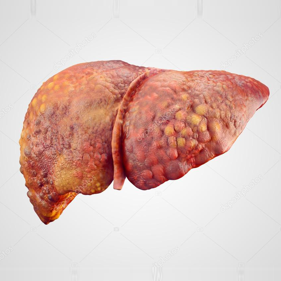 Cirrose hepática – Dra. Stephany Román Farfán